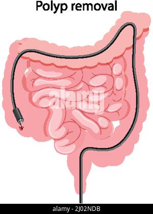 Diagram showing polyp removal illustration Stock Vector Image & Art - Alamy