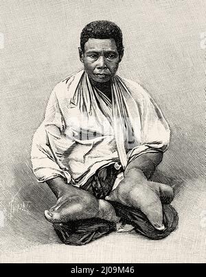 Man with Elephantiasis or Lymphatic Filariasis Stock Photo - Alamy