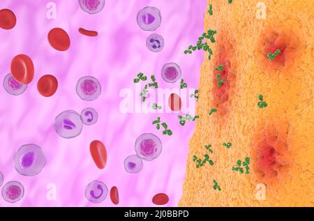 Rheumatoid arthritis (RA): in an autoimmune disease faultry activated b ...