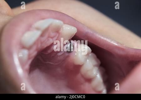 Real mouth with dental molar screw implant Stock Photo - Alamy
