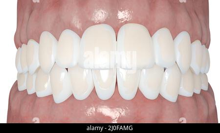 Dental demineralization, illustration Stock Photo - Alamy