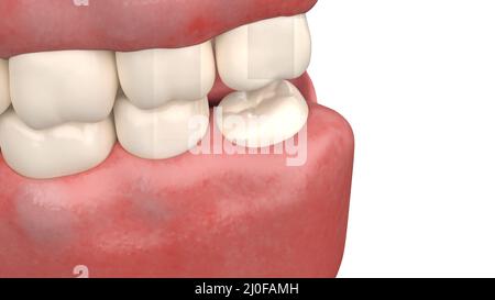 Impacted wisdom tooth, illustration Stock Photo - Alamy
