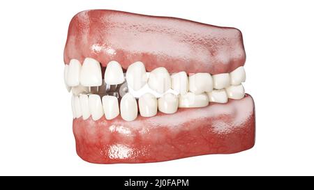 Open bite, illustration Stock Photo - Alamy