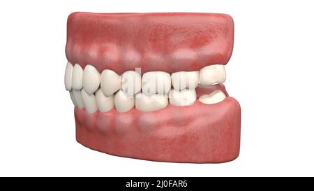 Impacted tooth, illustration Stock Photo - Alamy