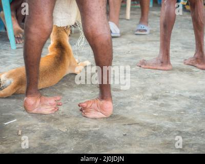 A person with leg deformities due to polio or other diseases in the ...