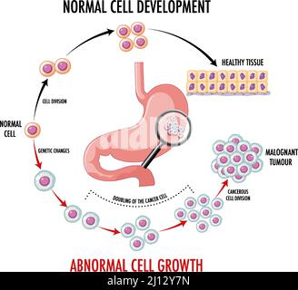 Diagram showing normal and cancer cells illustration Stock Vector Image ...