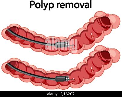 Diagram showing polyp removal illustration Stock Vector Image & Art - Alamy