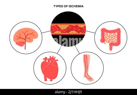 Types of ischaemic, illustration Stock Photo - Alamy