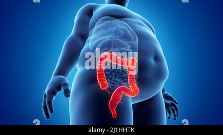Obese man's colon, illustration Stock Photo - Alamy
