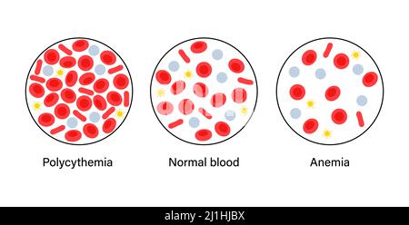 Normal and diseased blood composition, illustration Stock Photo - Alamy