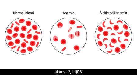 Normal and diseased blood composition, illustration Stock Photo - Alamy