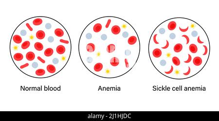 Normal and diseased blood composition, illustration Stock Photo - Alamy