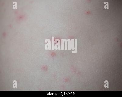 Treatment of ulcers from chickenpox, varicella with medical cream on ...