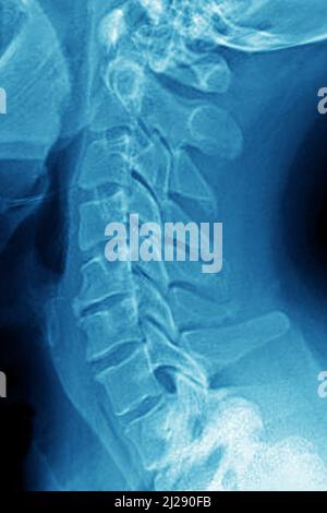 CERVICAL OSTEOARTHRITIS, X-RAY Stock Photo - Alamy