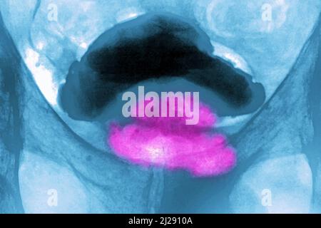 X-ray imagery or radiography of human male pelvis and lumbar vertebrae ...
