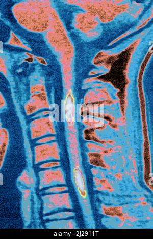 Multiple sclerosis. Magnetic resonance imaging (MRI) scans of contiguous axial sections of the ...