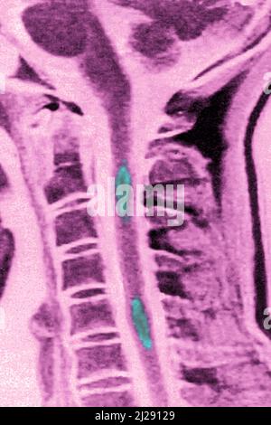 Multiple sclerosis or MS autoimmune disease with healthy nerve and ...
