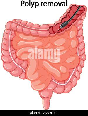 Diagram showing polyp removal illustration Stock Vector Image & Art - Alamy
