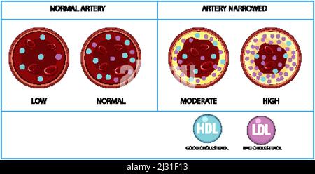 Types of Cholesterol HDL and LDL illustration Stock Vector Image & Art ...
