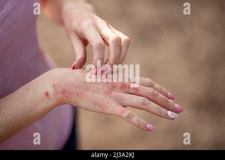 Atopic dermatitis, Red, itchy hands with blisters and chapped skin ...