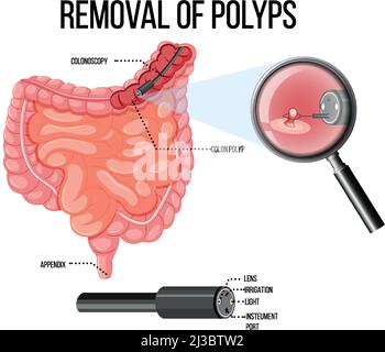 Diagram showing removal of polyps illustration Stock Vector Image & Art ...