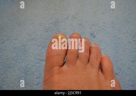 Toenail Fungus (big toe + four toes) 2 Stock Photo - Alamy