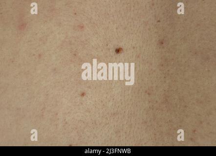 Moles on different parts of the body Stock Photo - Alamy