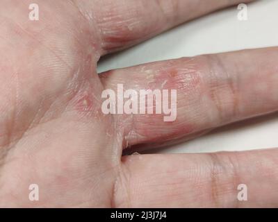 Hand with eczema Stock Photo - Alamy