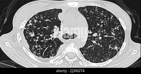Miliary tuberculosis, chest ct scan Stock Photo - Alamy