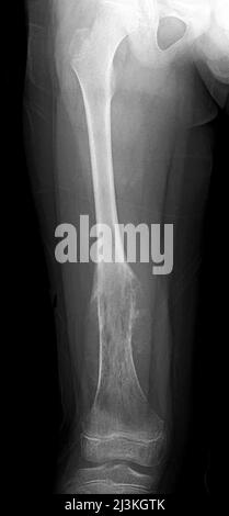 Bone cancer of the femur, X-ray Stock Photo - Alamy