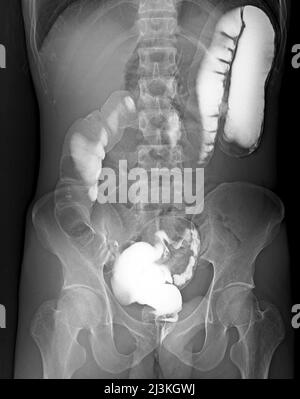 Colon malrotation, X-ray Stock Photo - Alamy