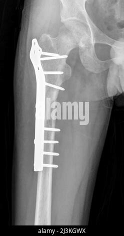 Pinned broken leg, X-ray Stock Photo - Alamy