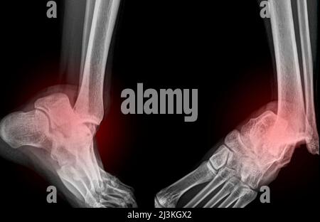 X-ray, surgery for an ankle fracture dislocation Stock Photo - Alamy