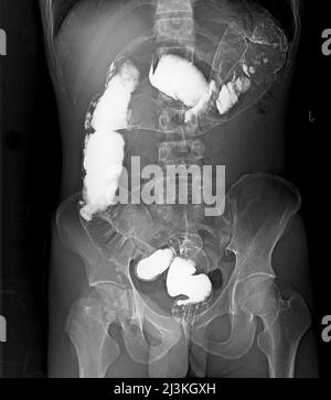 Colon malrotation, X-ray Stock Photo - Alamy