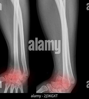 Broken hand bone. Coloured X-ray of the right hand of a patient ...