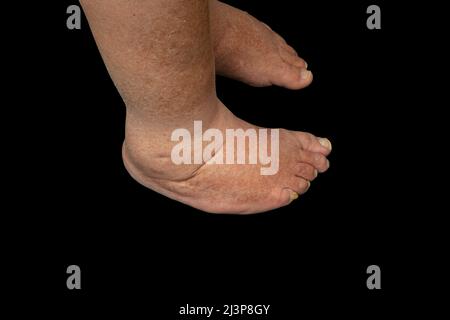 A man with clubfoot (talipes) standing on a black background. Both feet ...