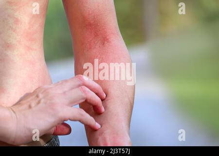 Patient suffering from the skin disease 'erythema multiforme'; Erythema ...