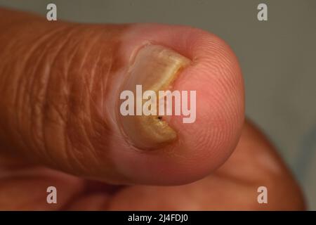 Plicatured nail condition may relate to other medical conditions Stock ...