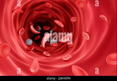 Sickle cell Anaemia (Sickle cell disease SCD) cells in the blood flow ...