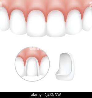 veneers teeth vector Stock Vector Image & Art - Alamy