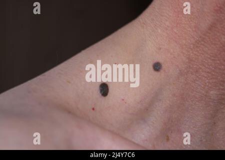 BENIGN SKIN TUMOR Stock Photo - Alamy