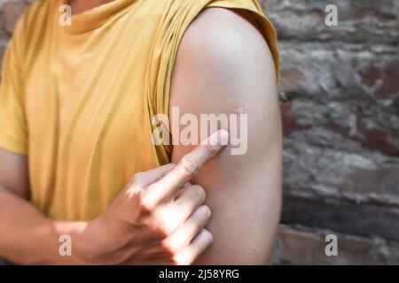 BCG or TB vaccine scar mark at the arm of Southeast Asian man Stock ...