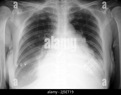 Enlarged heart, X-ray Stock Photo - Alamy