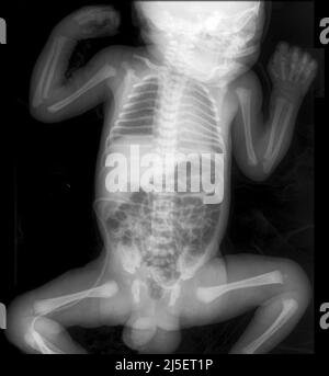 One day old baby, X-ray Stock Photo - Alamy