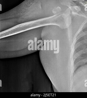 Dislocated right shoulder, X-ray Stock Photo - Alamy