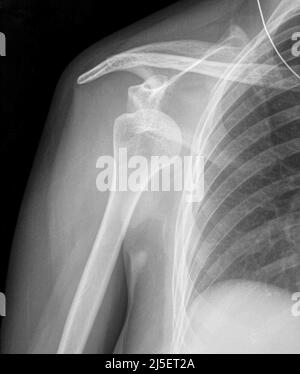 Dislocated right shoulder, X-ray Stock Photo - Alamy