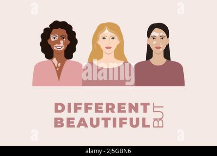Woman with different skin colors and vitiligo spots on body symbolizes ...