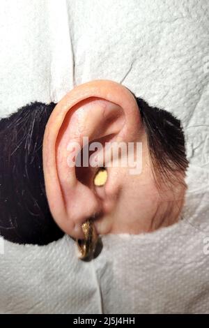 Human ear with yellow gray inside clogged ear canal close-up Stock ...