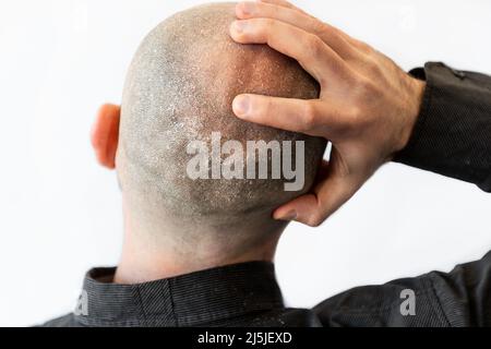 Male bald flaky head with dandruff close-up, back view. White ...