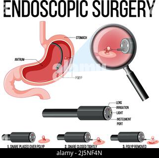 Diagram showing endoscopic surgery illustration Stock Vector Image ...